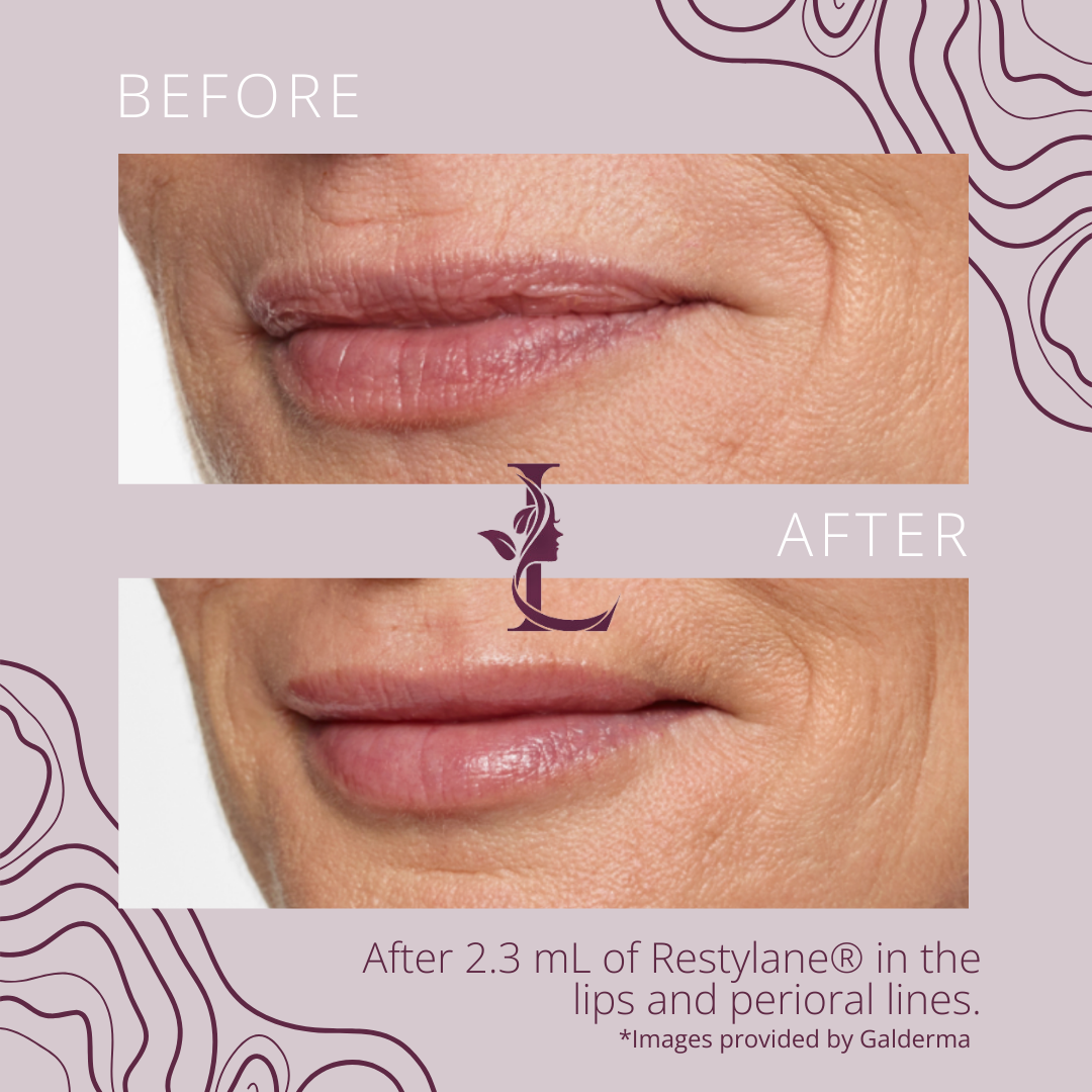 Lip Fillers – Luminous Medical Aesthetics